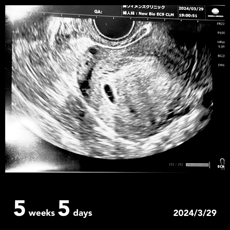 6w3d 胎嚢のみでした【お腹の赤ちゃんのこと】｜ベビーカレンダー専門家相談