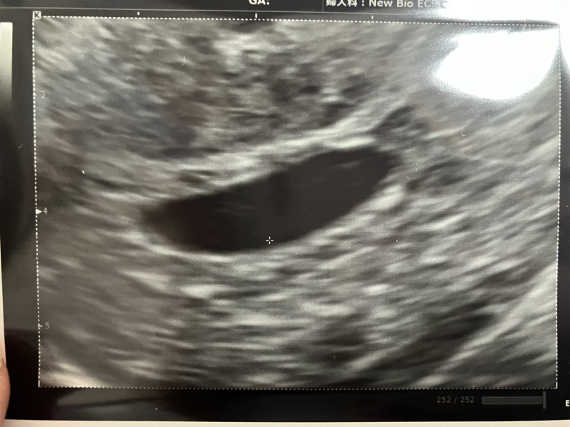 6w3d 胎嚢のみでした【お腹の赤ちゃんのこと】｜ベビーカレンダー専門家相談